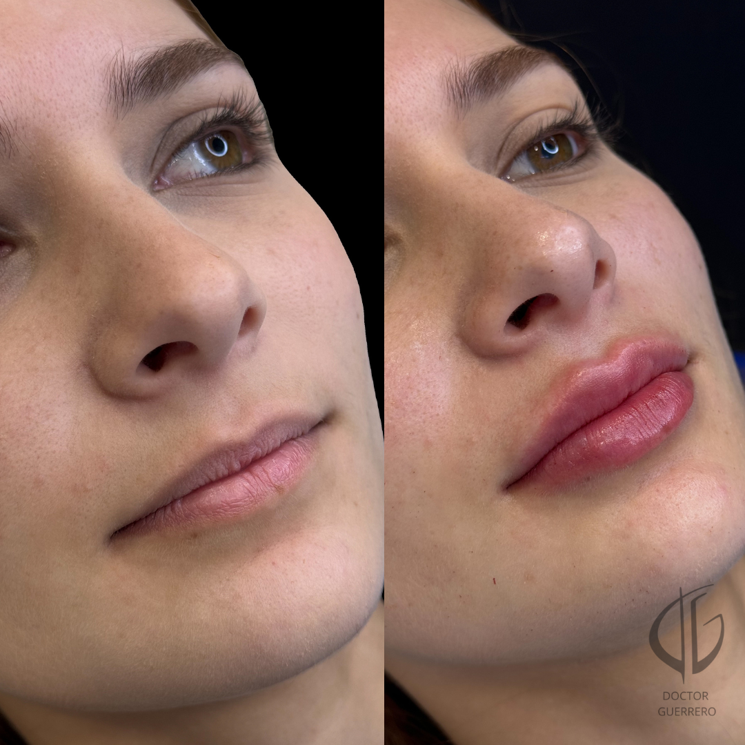 Aumento de labios - Clínica Dental Guerrero